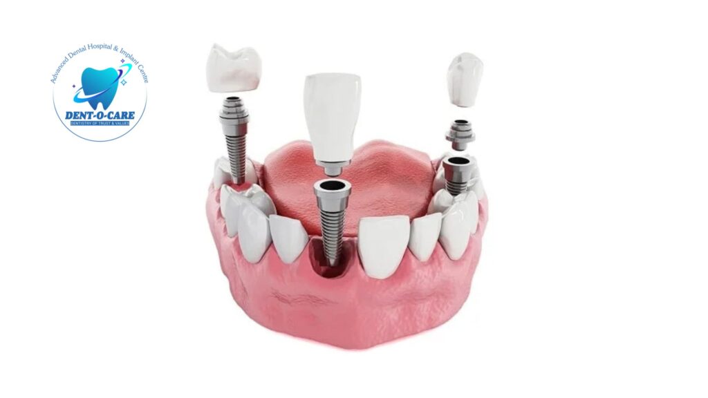 Best Dental Implants: Everything You Should Know in 2026